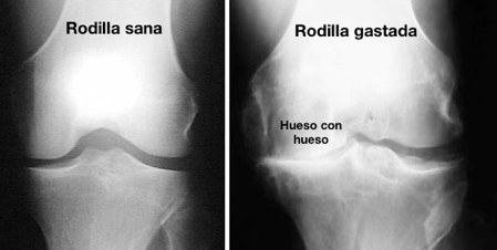 Desgaste del Cartílago o Artrosis y su Tratamiento - InmunoFuerte